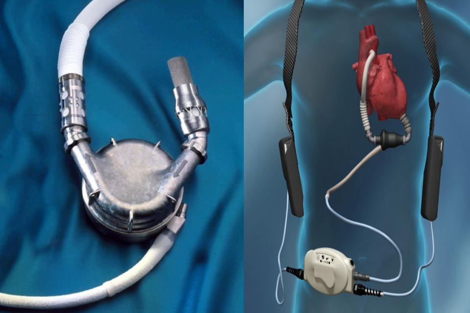 Ventricular Assist Devices (VADs) | LVAD, RVAD, BiVAD | Indications ...